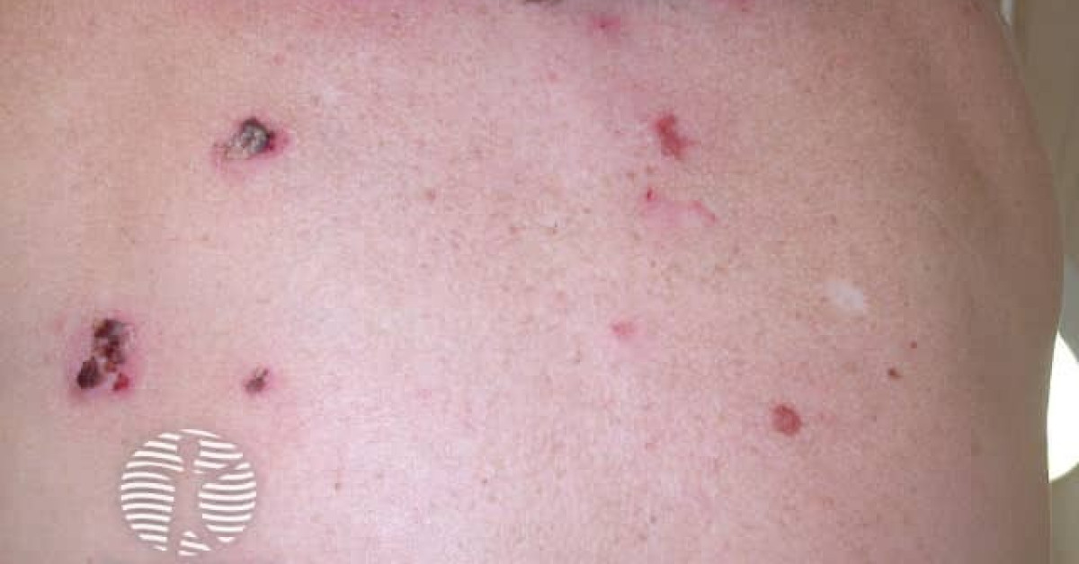 Pemphigus vulgaris image