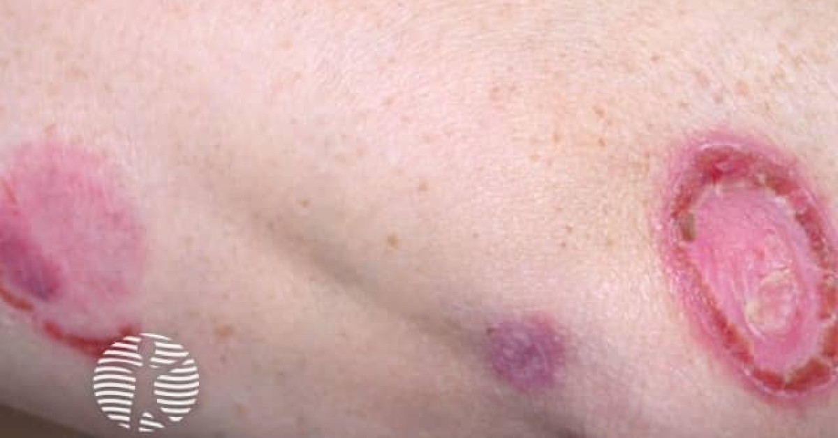 Pemphigus vulgaris image