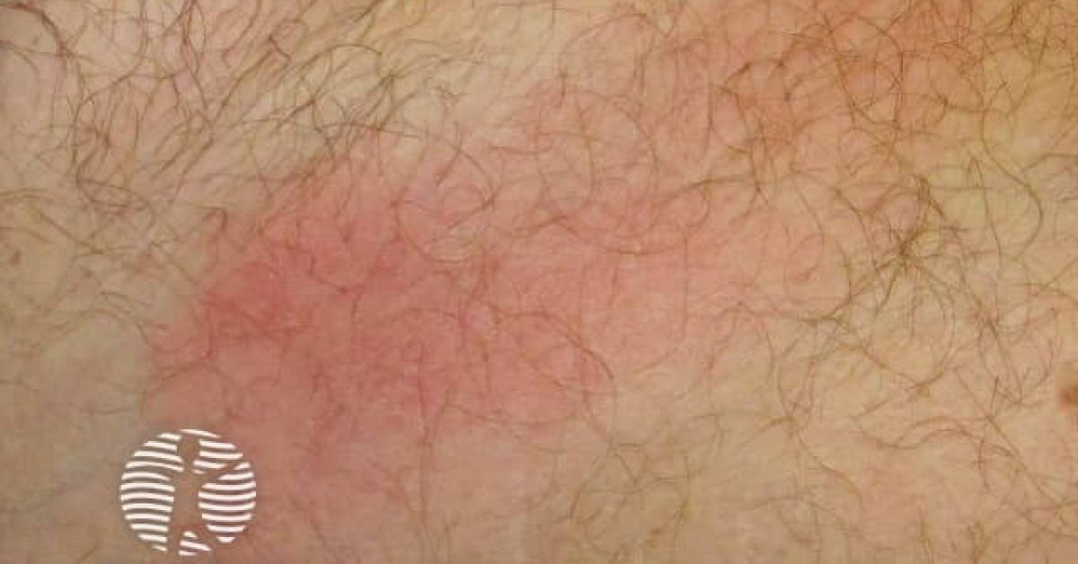 Periodic fever image