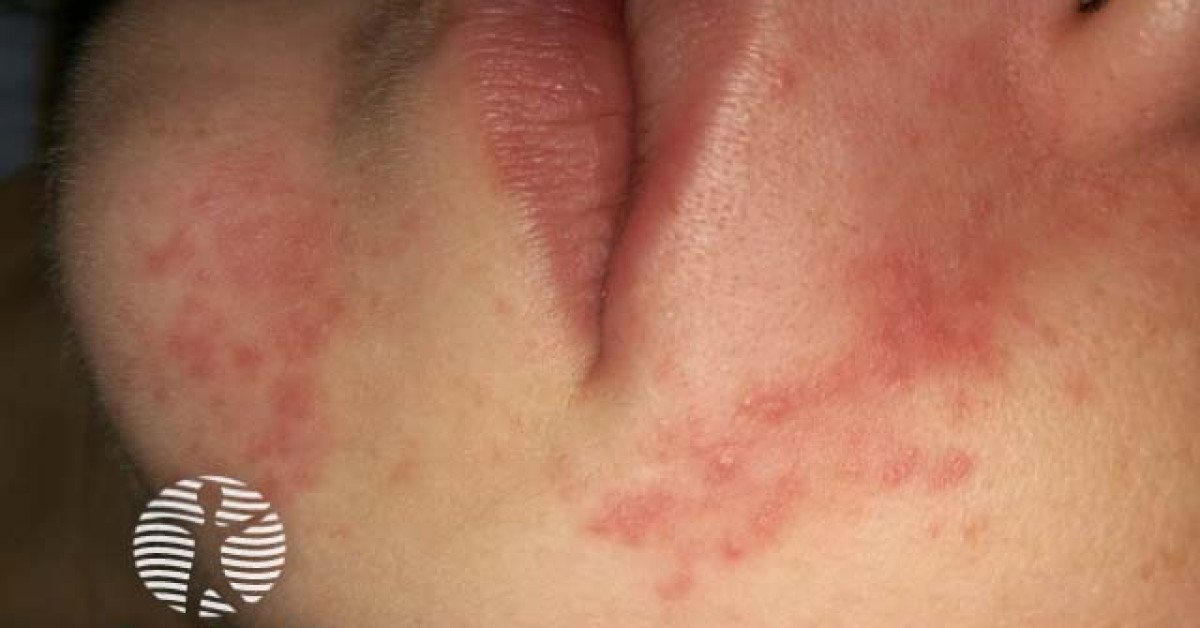 Perioral dermatitis image