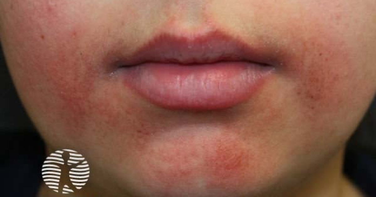 Periorbital Dermatitis Dermnet