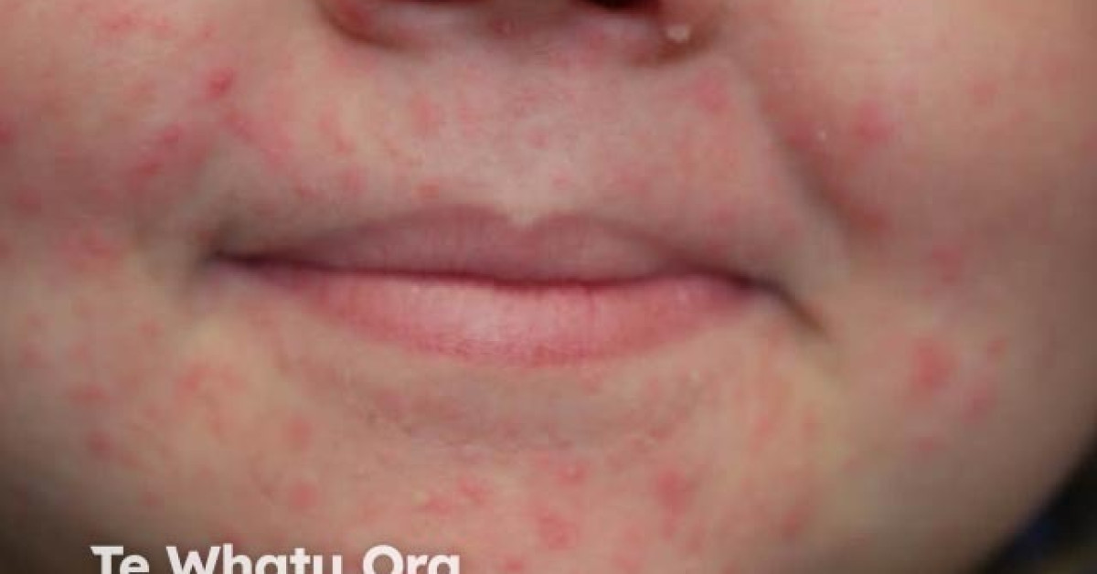 Periorificial dermatitis in a child image