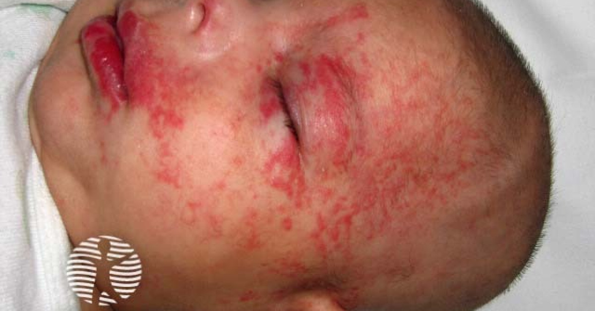 PHACES — segmental facial haemangioma image