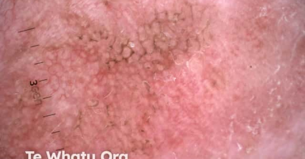 Dermoscopy of actinic keratosis image