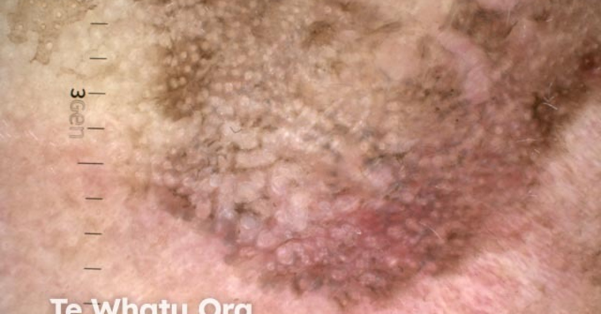 Annular granular pattern seen in dermoscopy of pigmented actinic ...