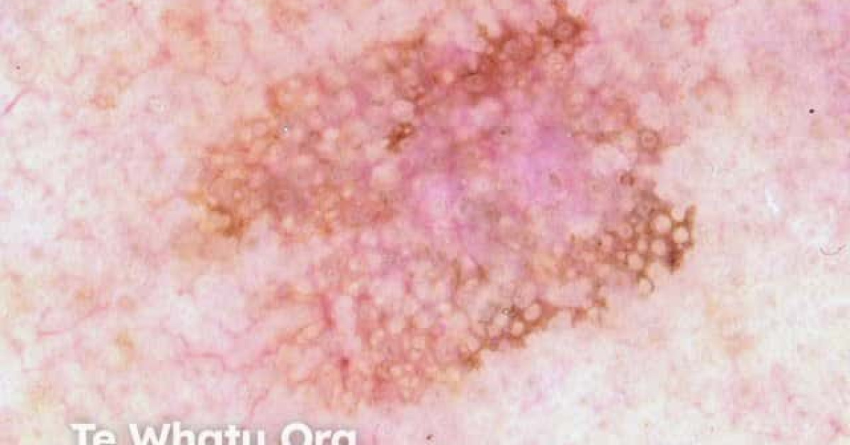Dermoscopy of pigmented actinic keratosis image
