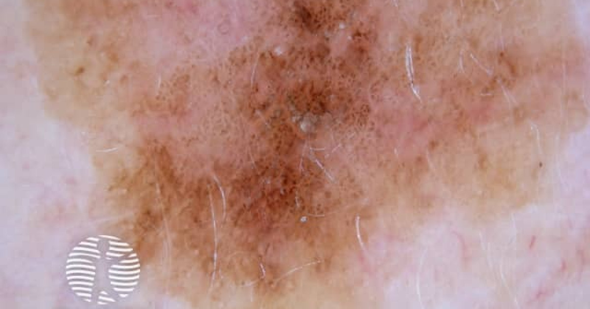 Dermoscopy of pigmented actinic keratosis image