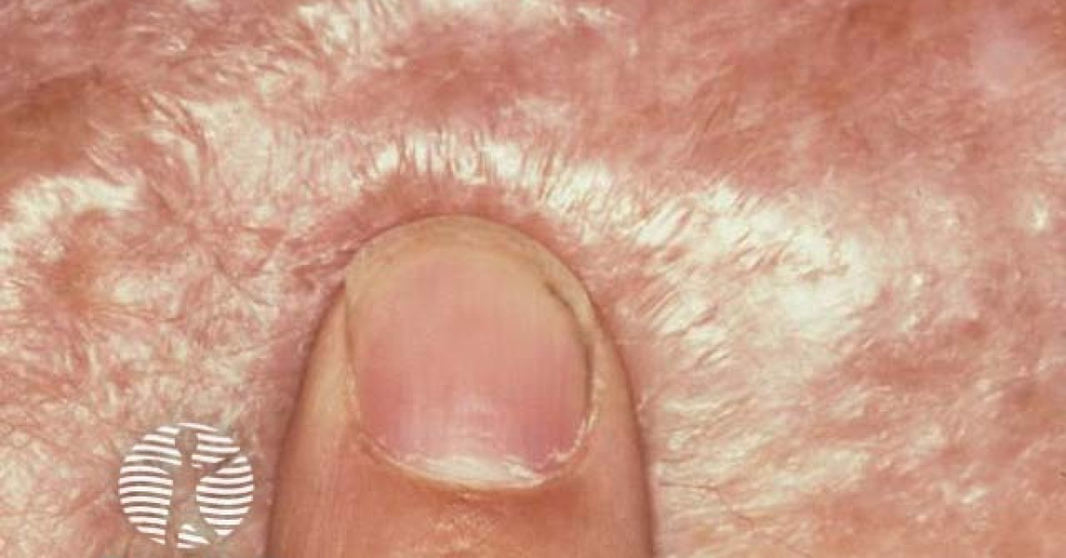 Pitting oedema image