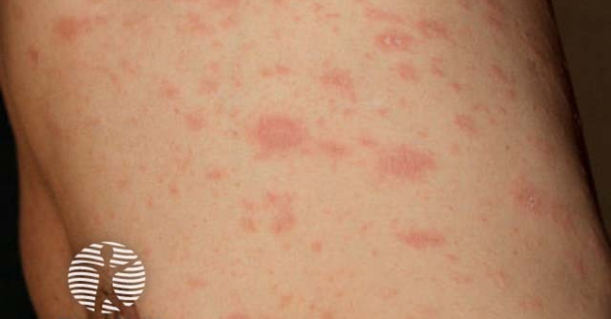 Pityriasis Rosea Treatment Dermnet