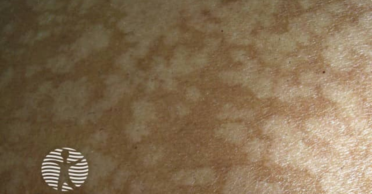 pityriasis versicolor 007 image