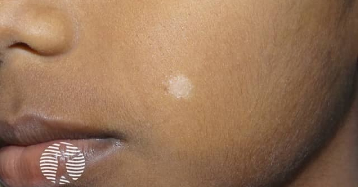 Hypopigmented pityriasis versicolor image