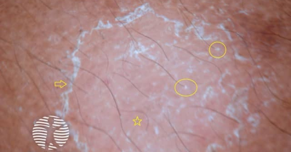 Hypopigmented pityriasis versicolor image