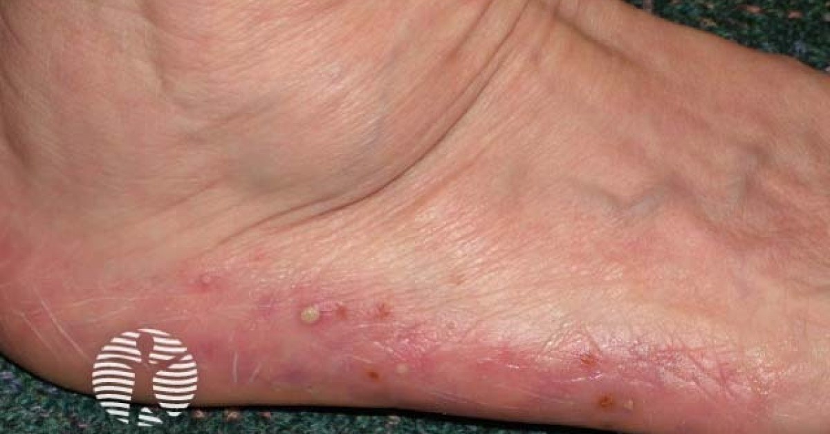 Plantar pustulosis image