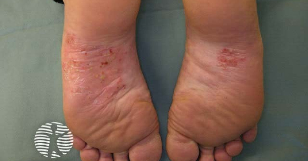 Plantar pustulosis image