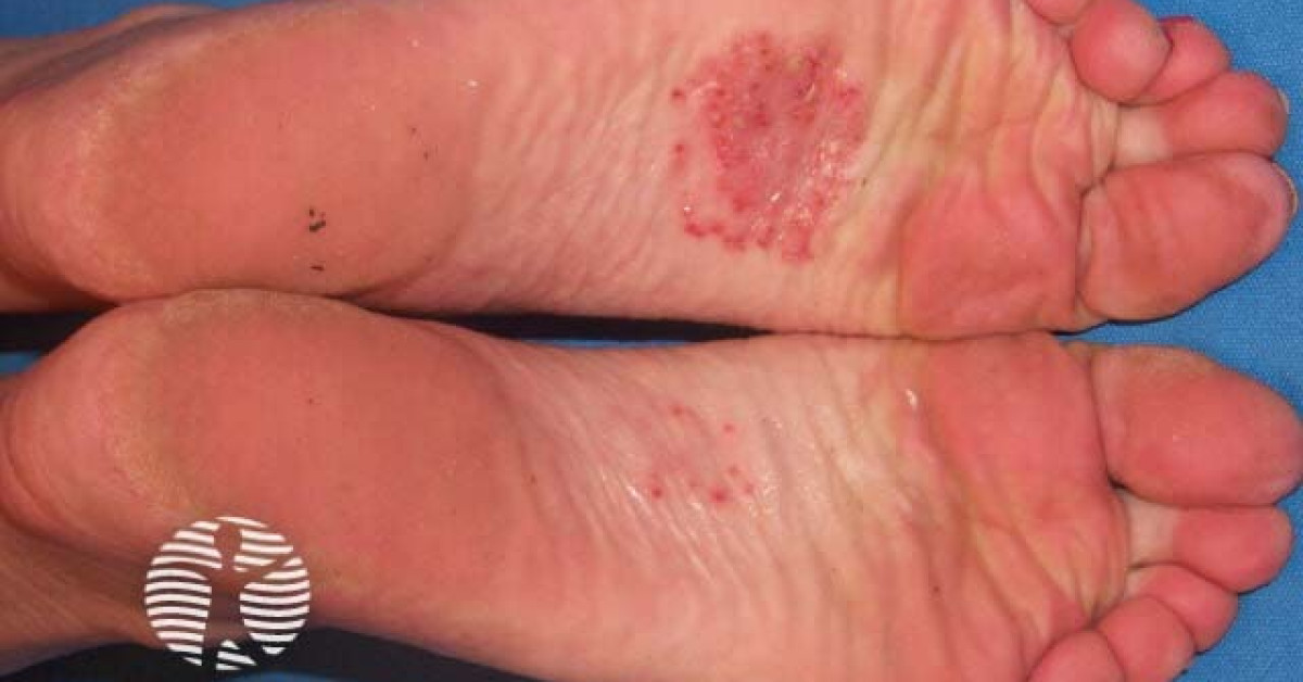Plantar pustulosis image