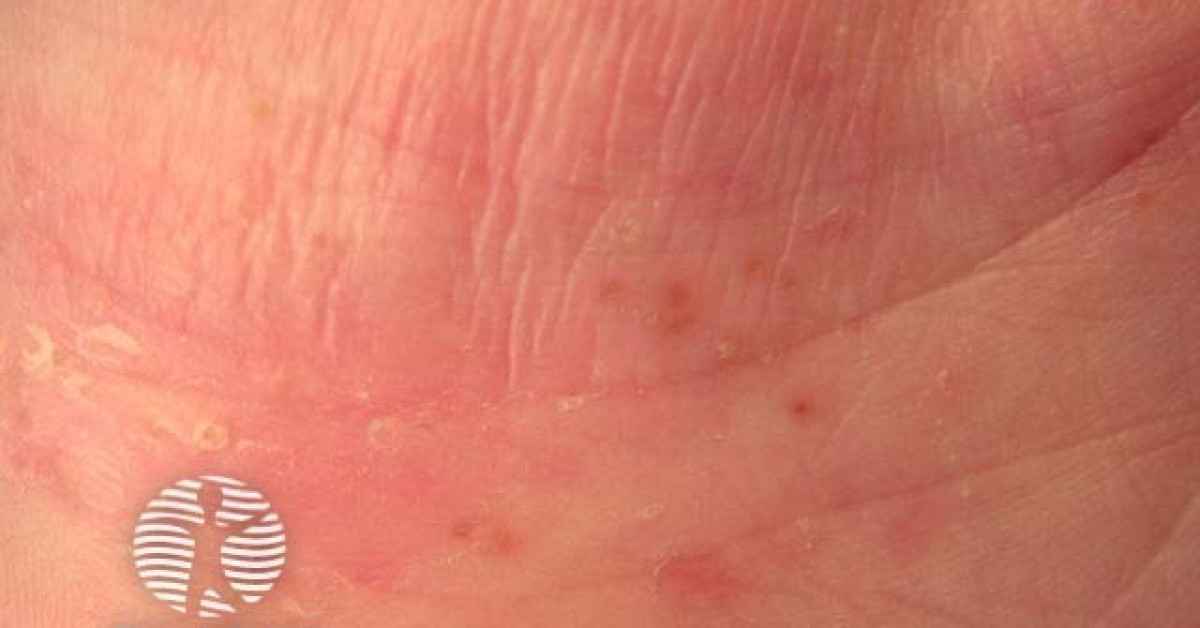 Plantar pustulosis image