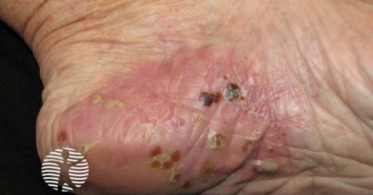Plantar pustulosis image