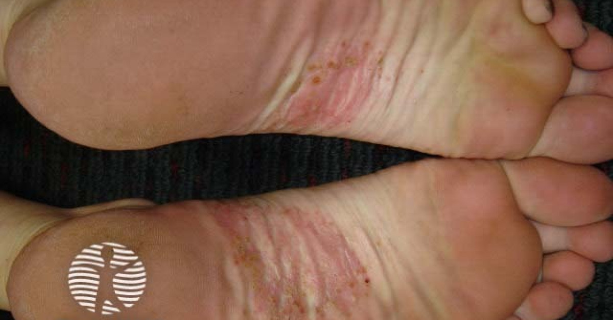 Plantar pustulosis image