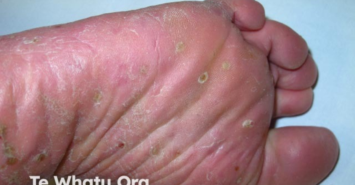 Plantar pustulosis image