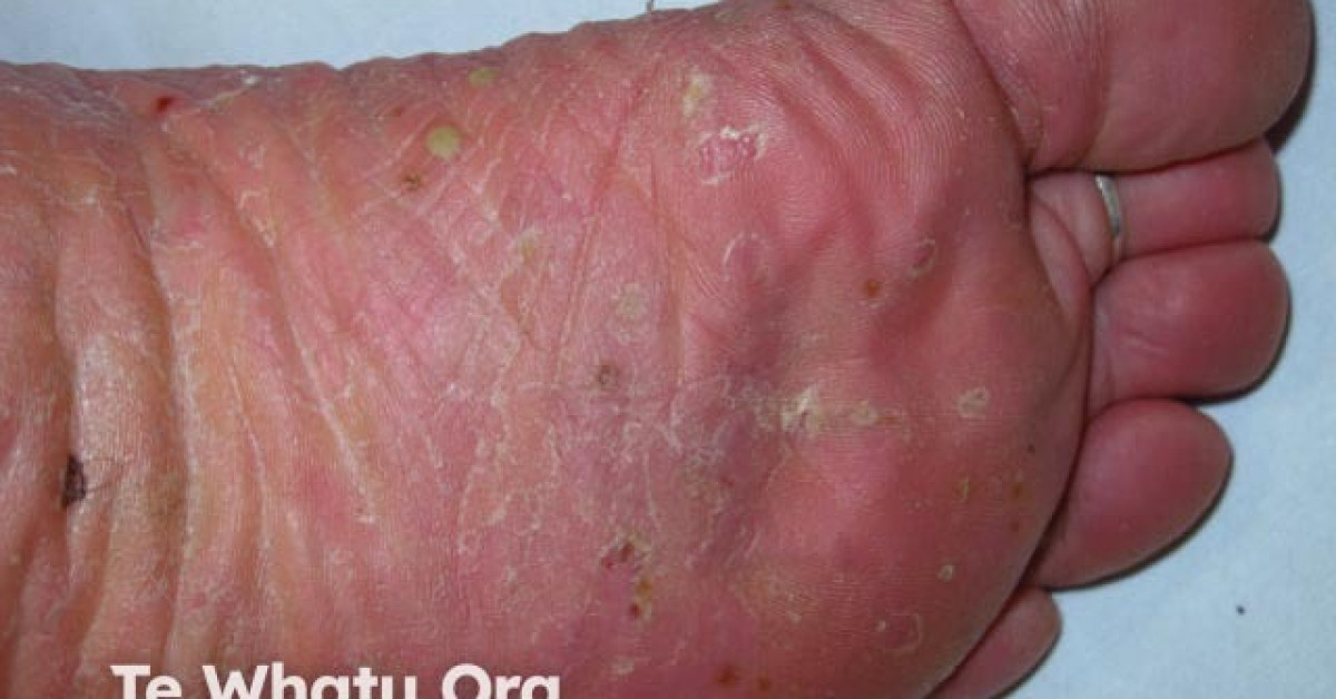 Plantar pustulosis image