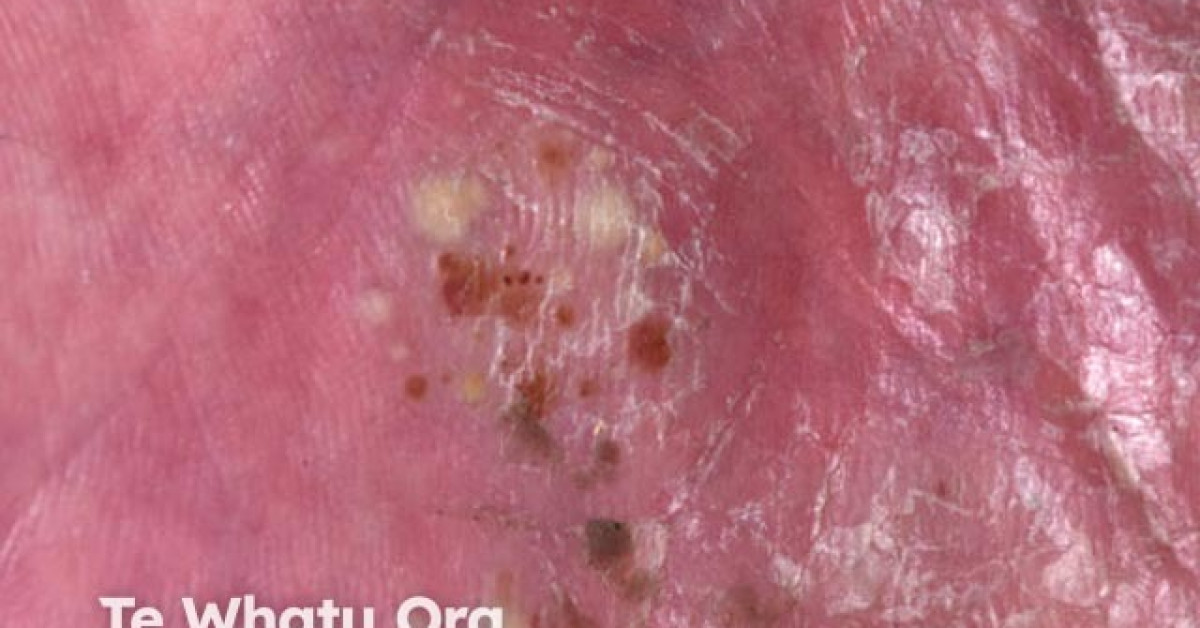 Plantar pustulosis image