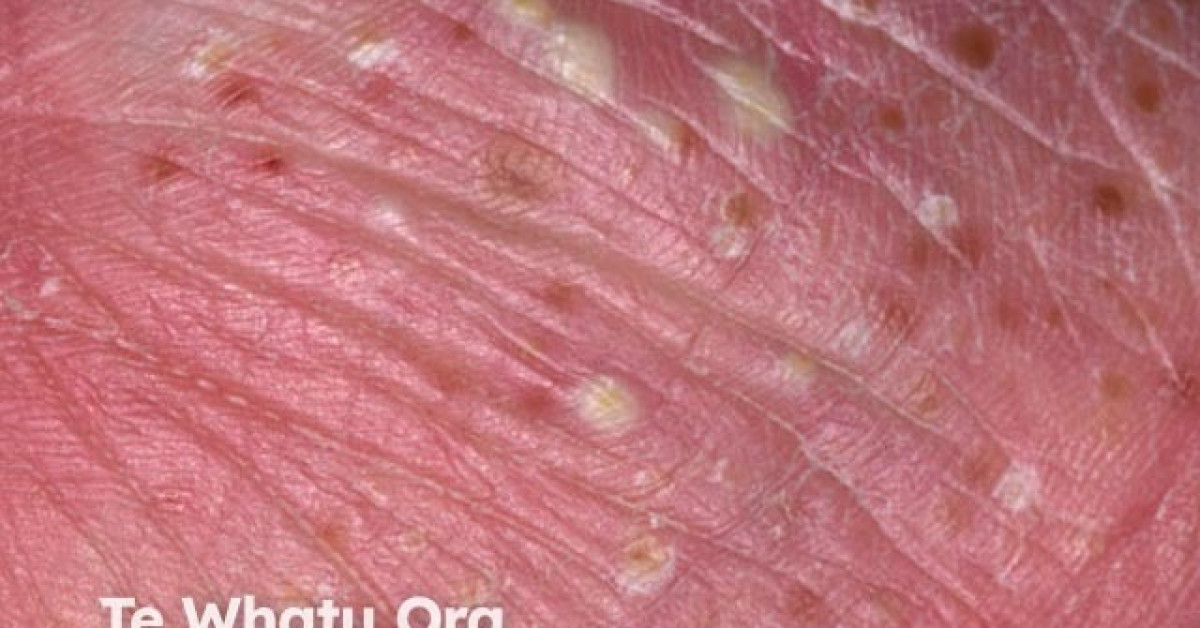 Plantar pustulosis image