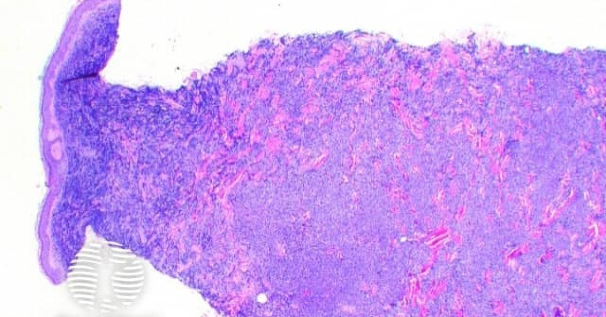 Plasmacytoma histology image