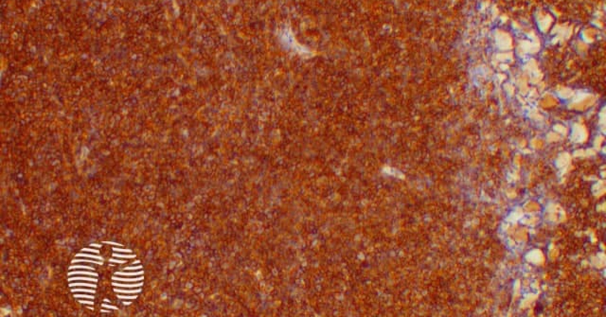 Plasmacytoma CD138 immunostaining image