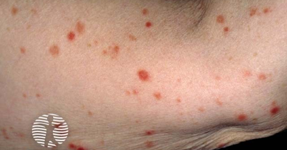 Pityriasis lichenoides chronica image