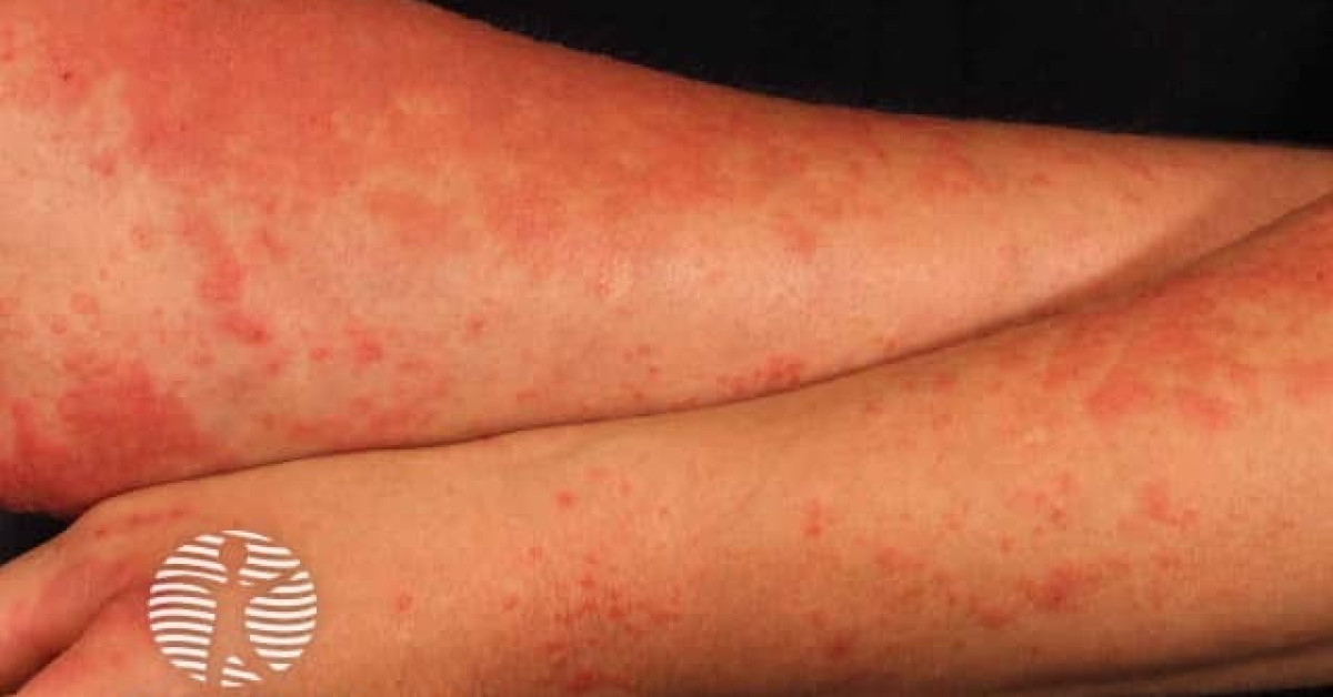 Polymorphic light eruption image