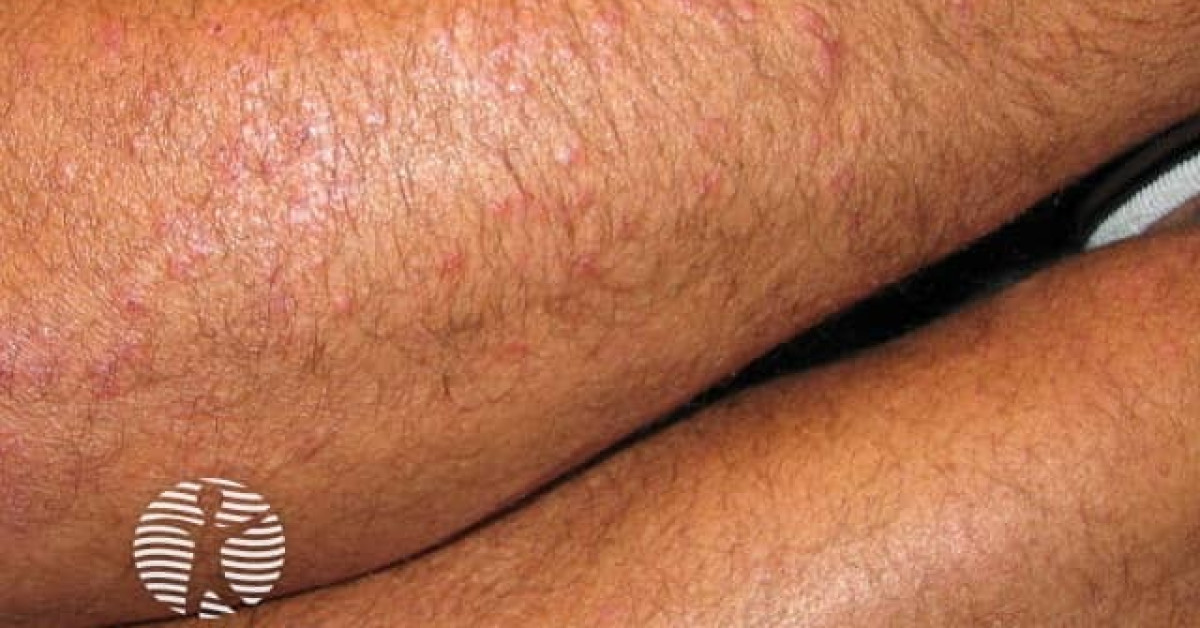 Polymorphic light eruption image