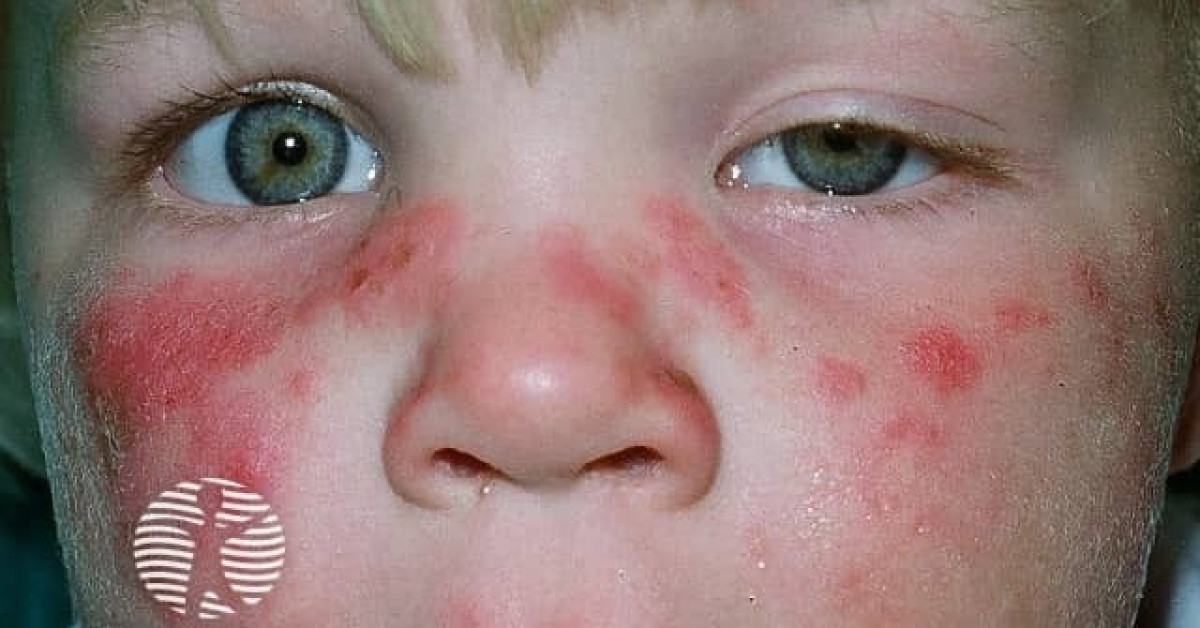 Polymorphic light eruption image