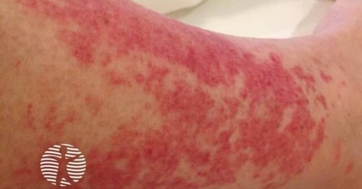 Polymorphic light eruption image