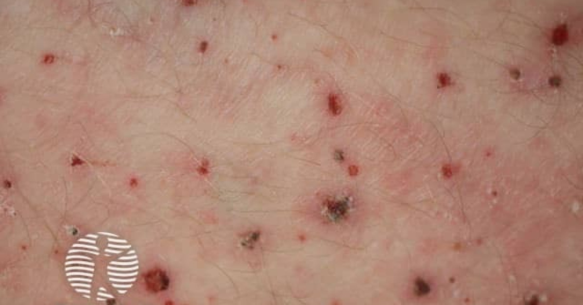 Polymorphic light eruption image