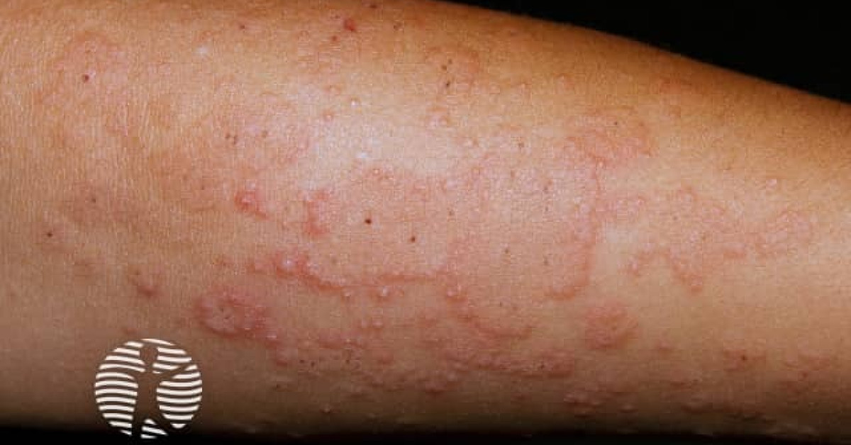 Polymorphic light eruption image