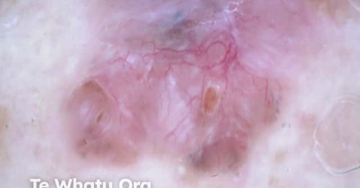 Polarised dermoscopy of pigmented basal cell carcinoma image