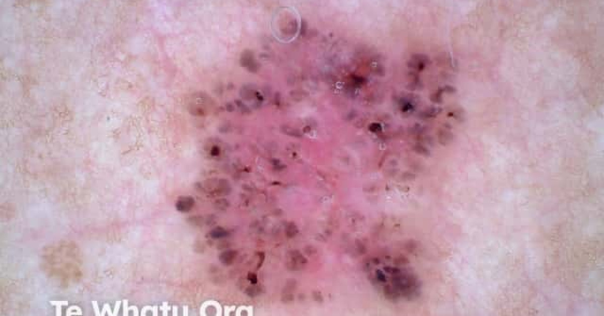 Polarised dermoscopy of pigmented basal cell carcinoma image