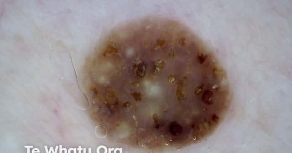 Polarised dermoscopy of seborrhoeic keratosis image