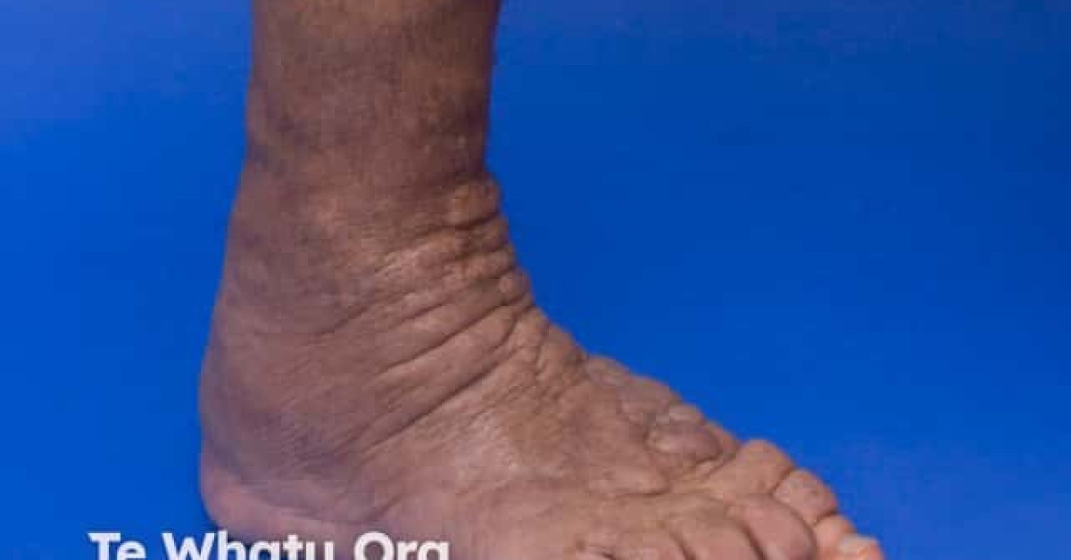 Pretibial myxoedema image