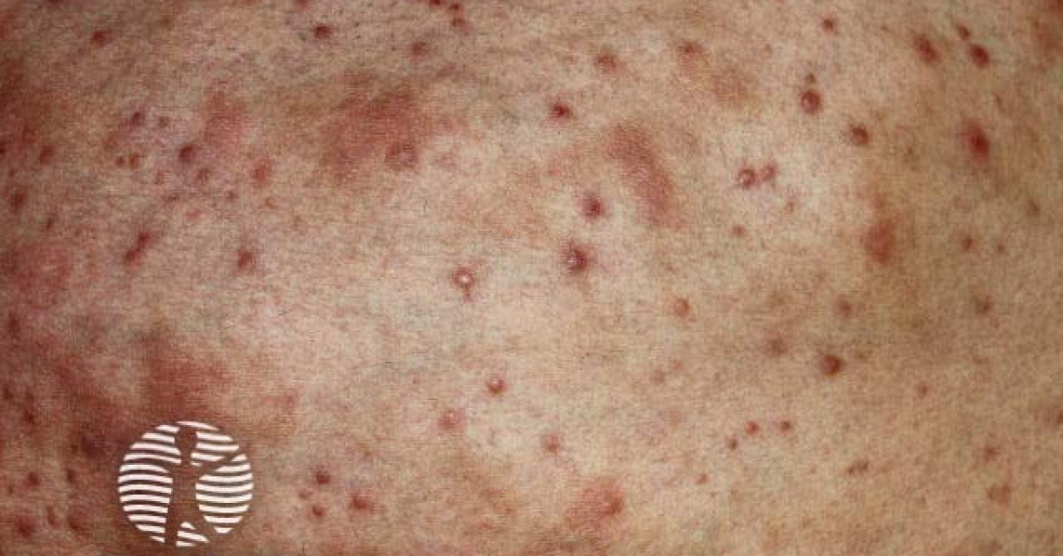 Primary cutaneous anaplastic large cell lymphoma image