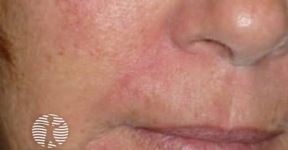 Primaryclosure3 image