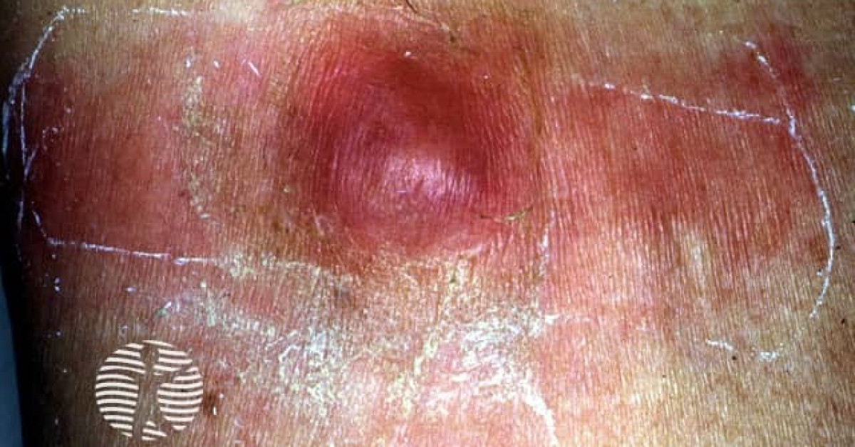 Abscess from collagen test image