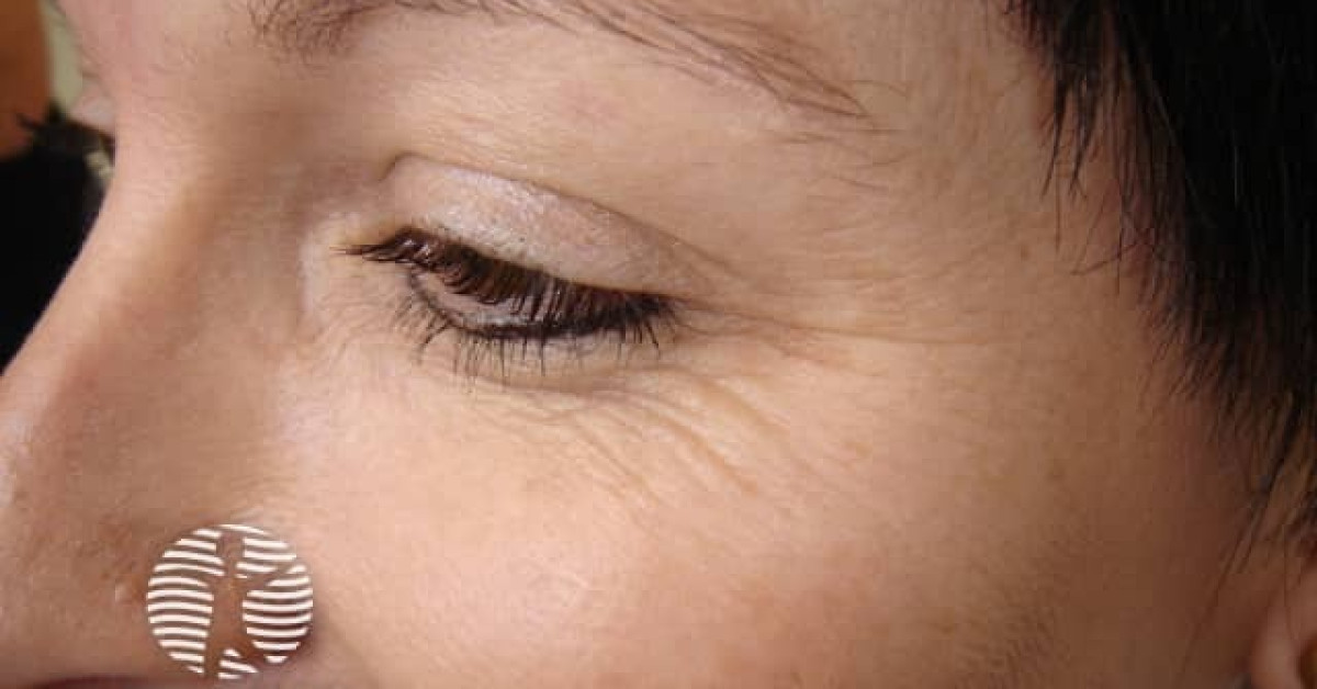 BOTOX® injections image