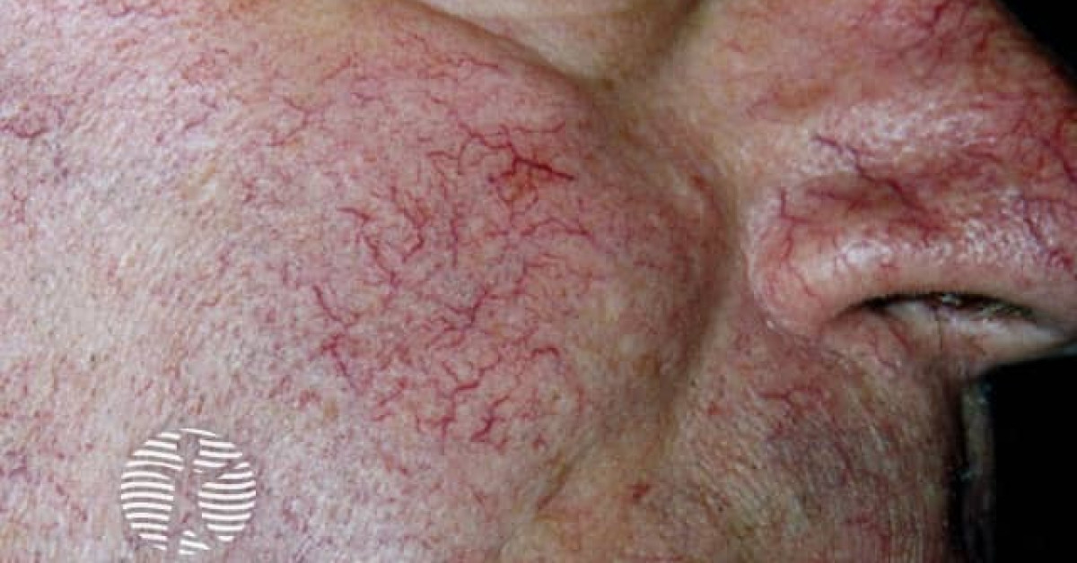 Telangiectasia image