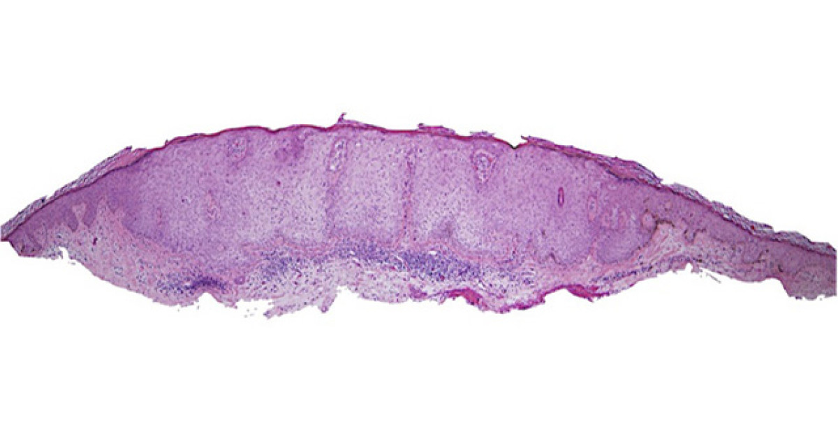 Histopathology of SCC in situ image