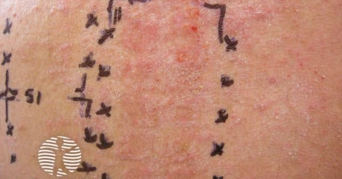 Patch tests: extension of dermatitis to surrounding skin image