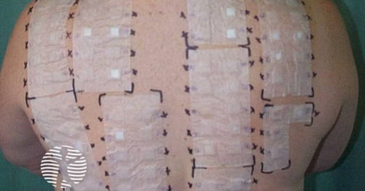 Image Display Dermnet Nz Examen Vistas DermNet New Zealand Patch Tests