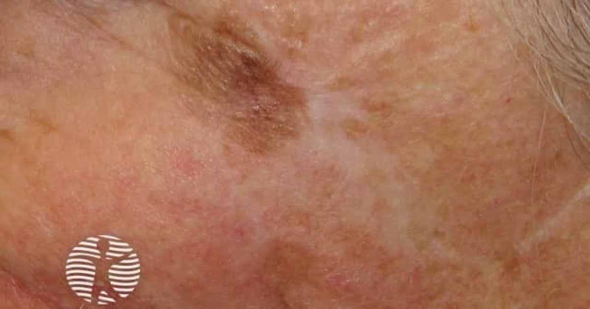 Recurrence of basisquamous cancer image