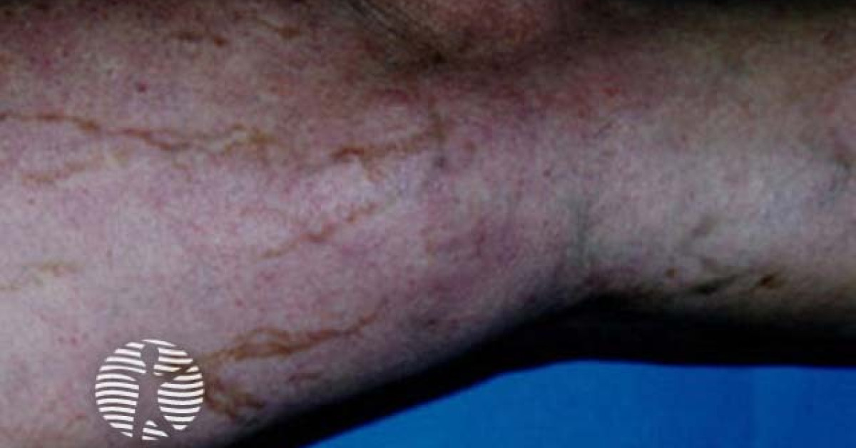 sclerotherapy image