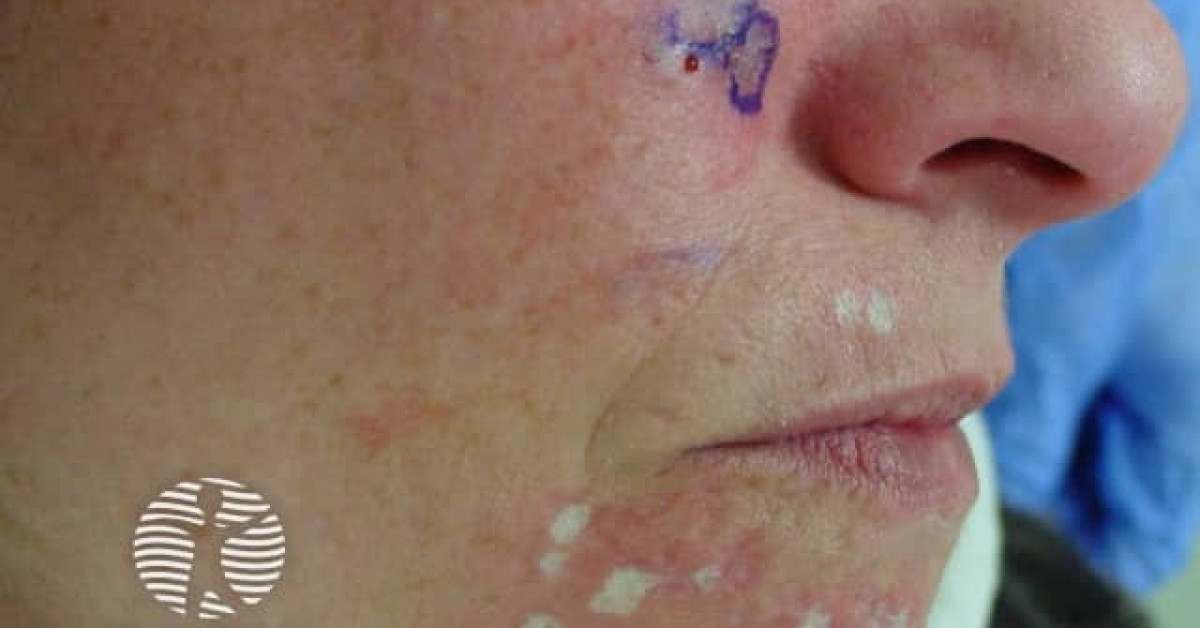 Subcision procedure image